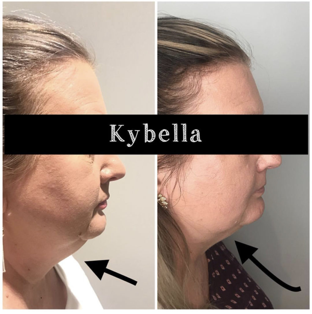 Kybella Injections in Gilbert, AZ | Colair Med Spa