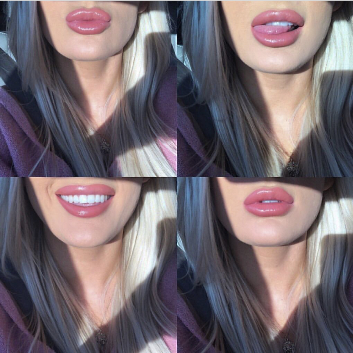 Lip Injections in Gilbert, AZ | Colair Luxury Med Spa