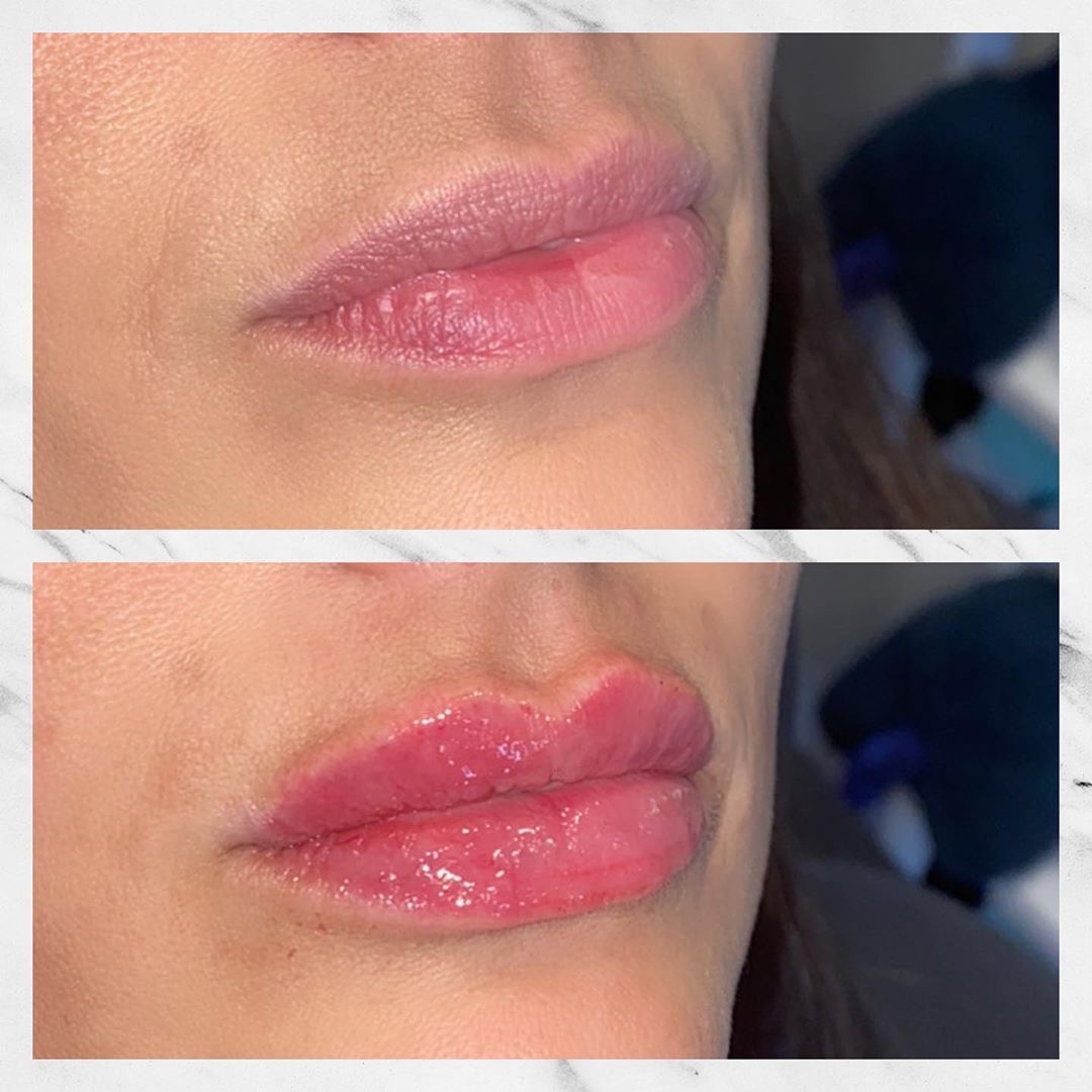 Lip Injections in Gilbert, AZ | Colair Luxury Med Spa