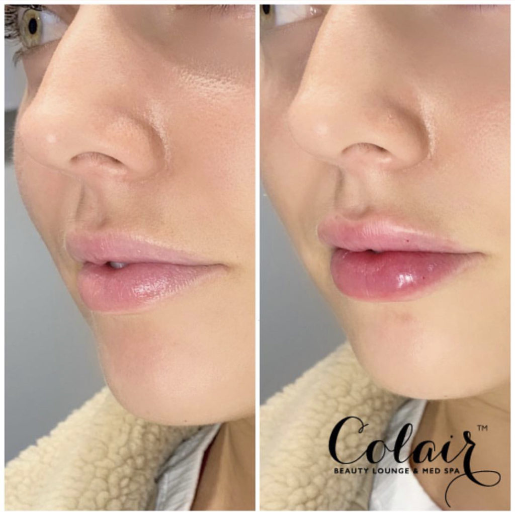 Lip Injections in Gilbert, AZ | Colair Luxury Med Spa