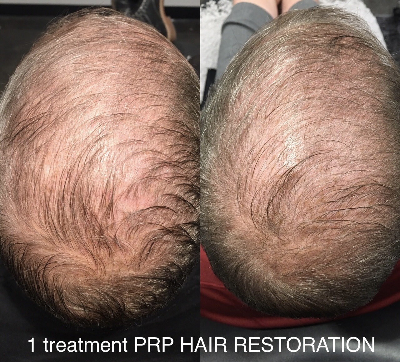 PRP Hair Treatment in Gilbert AZ | Colair Luxury Med Spa