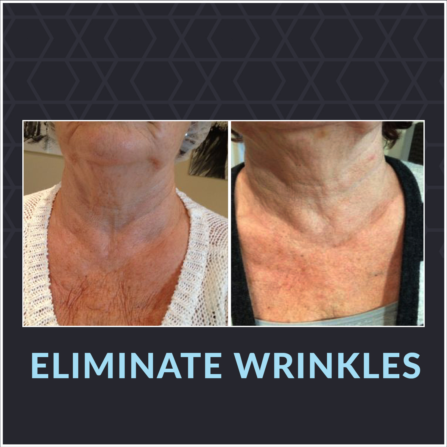 Scarlet RF Microneedling Gilbert | StemFacial & PRP Facial