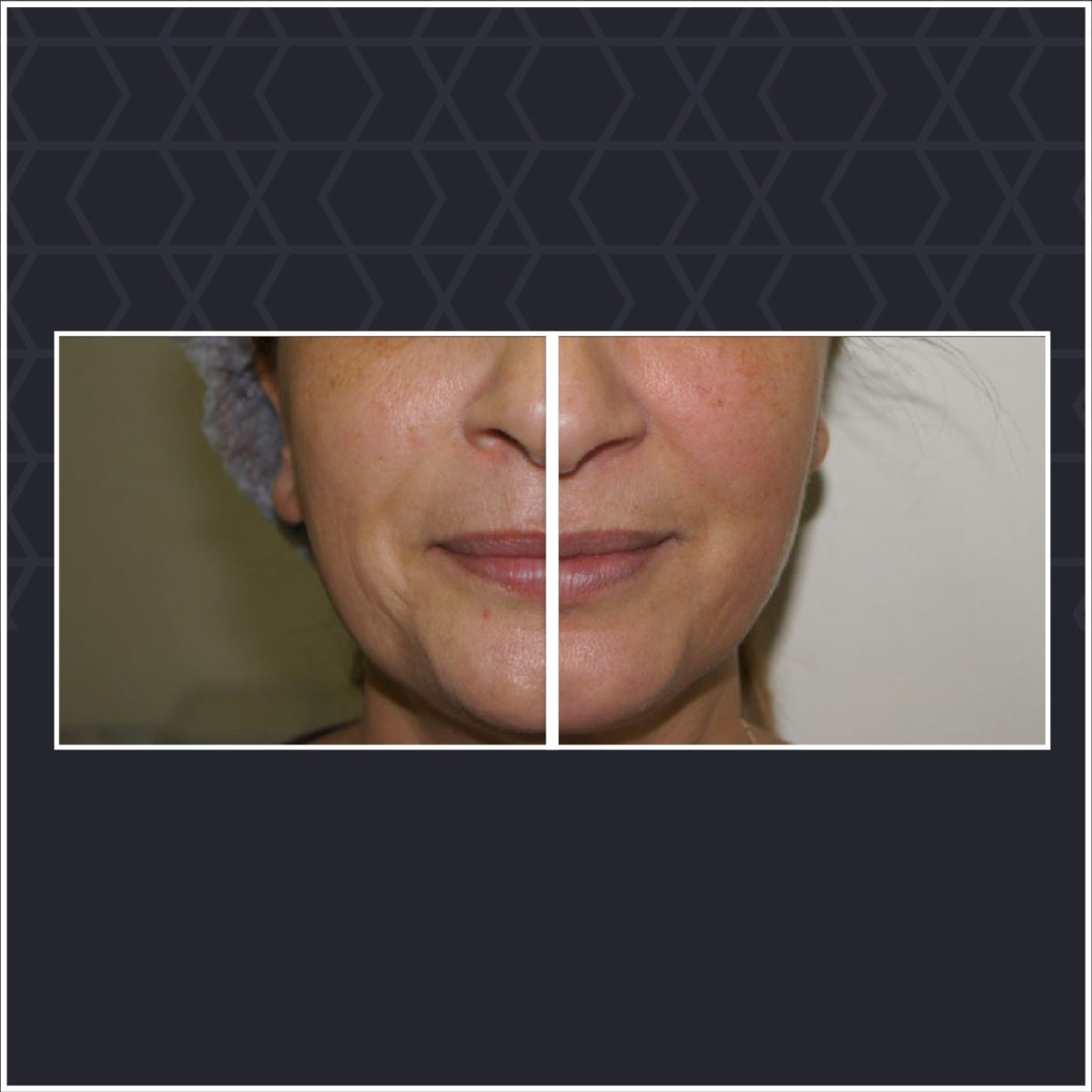 Scarlet RF Microneedling Gilbert | StemFacial & PRP Facial