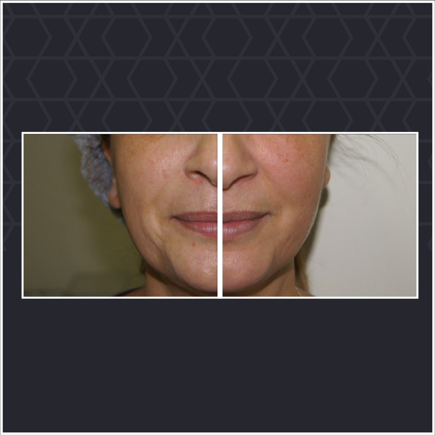 Scarlet RF Microneedling Gilbert | StemFacial & PRP Facial