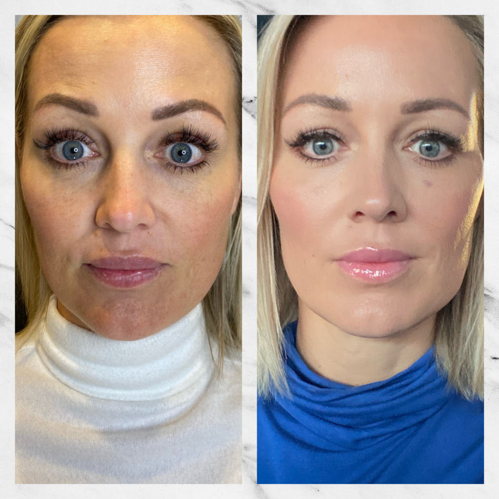 What is a PDO Thread Lift? | Colair Beauty Blog