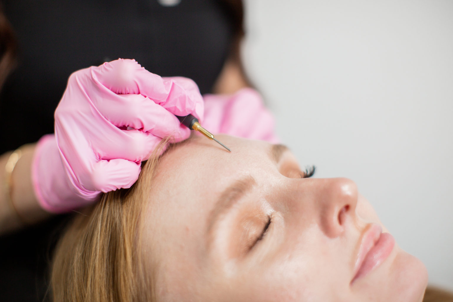 Lamprobe Treatment in Gilbert, AZ | Colair Med Spa