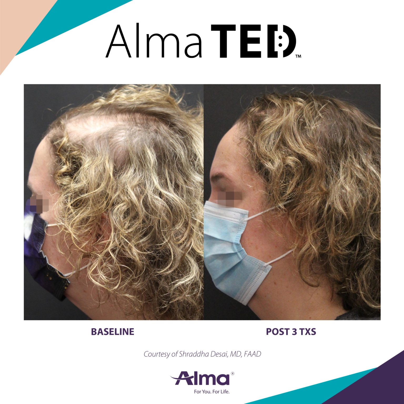 What is Alma TED for Hair Treatment? | Colair Beauty Lounge