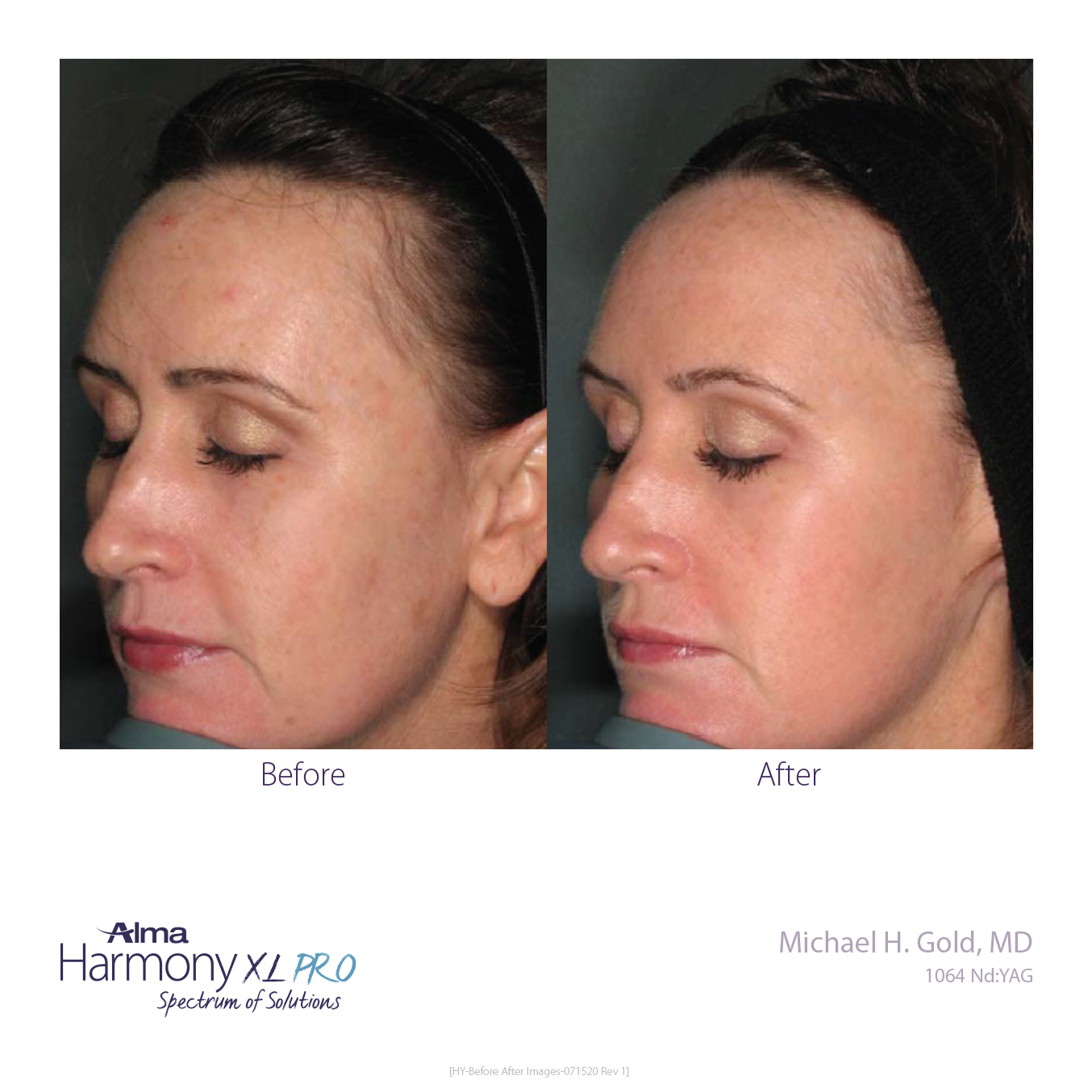 Fractional Laser Resurfacing for Aging Skin | Colair Med Spa