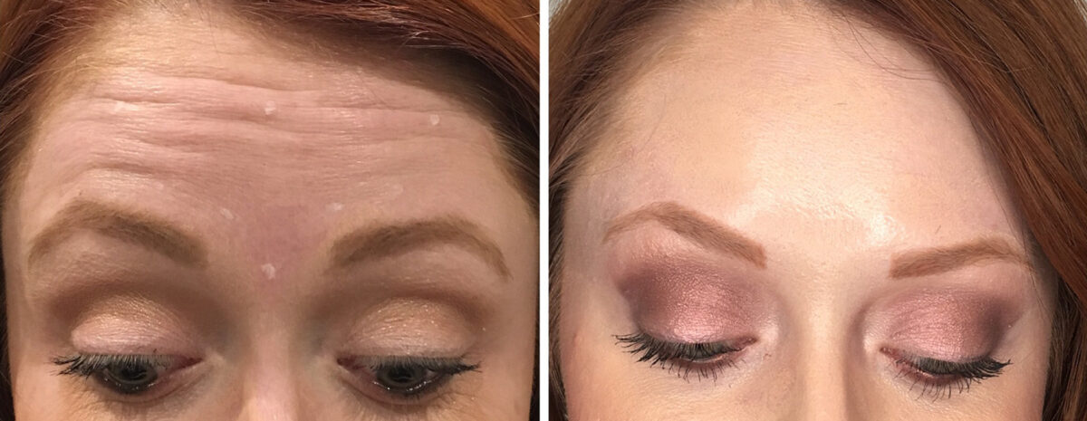 New to Botox? What to Expect Your First Time - Colair