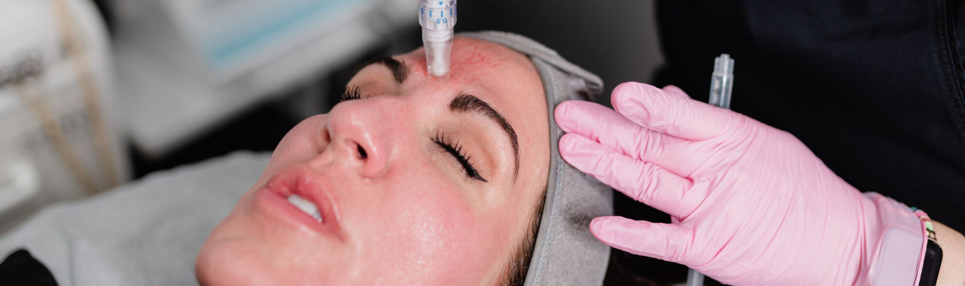 Scarlet RF Microneedling vs. Traditional Microneedling - Colair