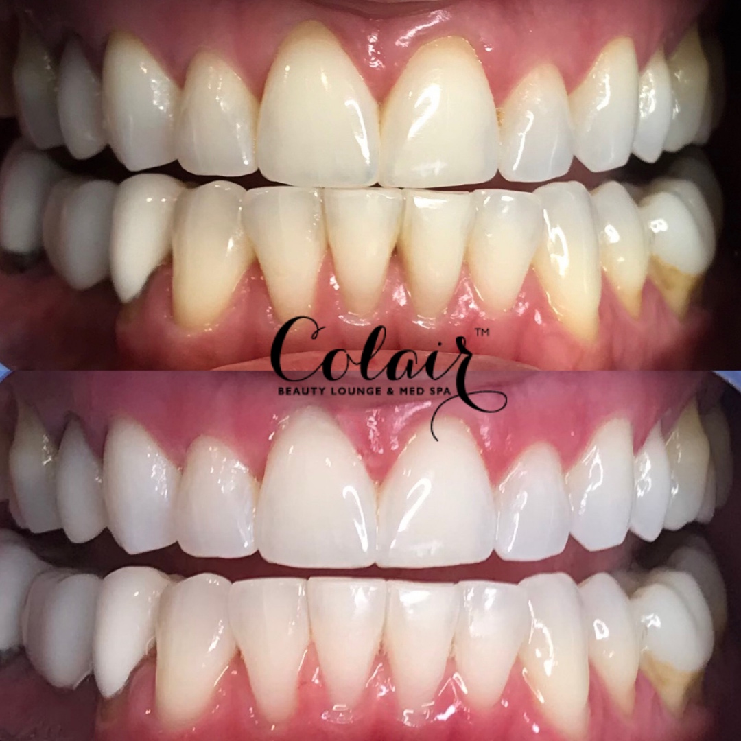 5 Tips for Maintaining Your Bright Smile After Teeth Whitening