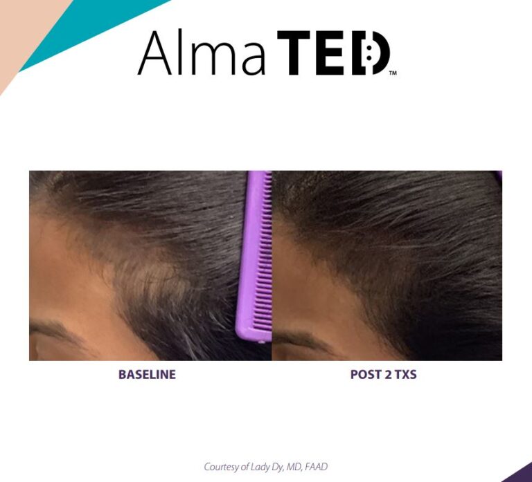 Everything You Need to Know About Alma TED - Colair