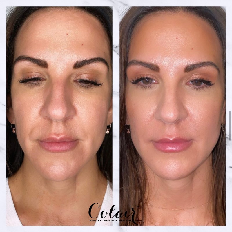Filler - Colair Beauty Lounge & Med Spa